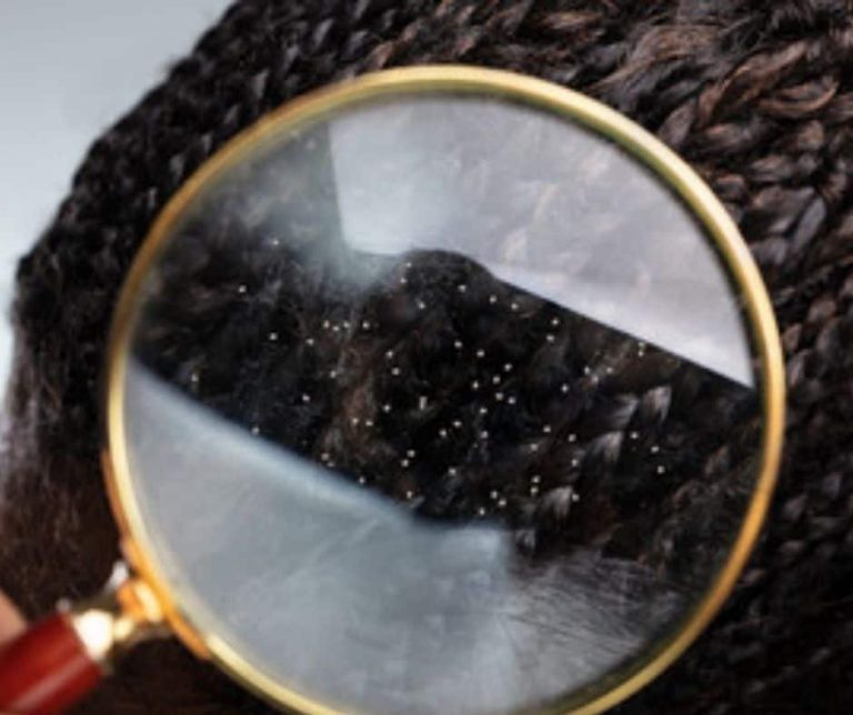How to get rid of lice in African-American hair - ReenaSidhu